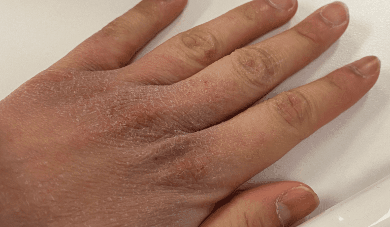 How to Clean Your House If You Have Contact Dermatitis